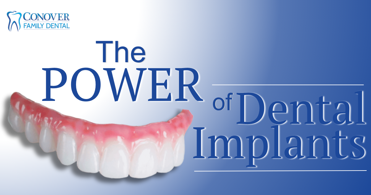 Dental Implants | Cincinnati, OH Dentist